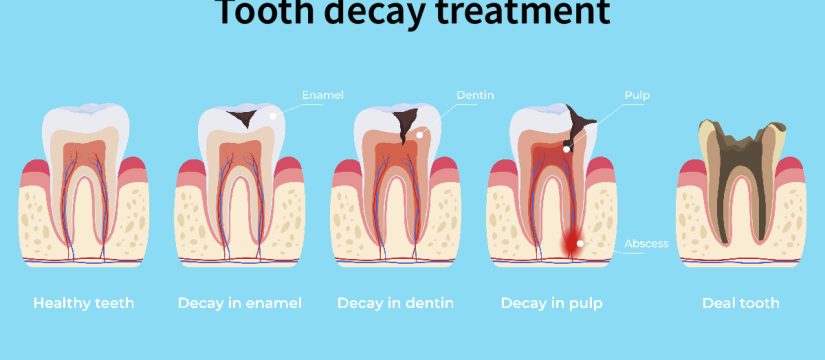 Tooth decay treatment in Saudi Arabia | Tooth cavity treatment